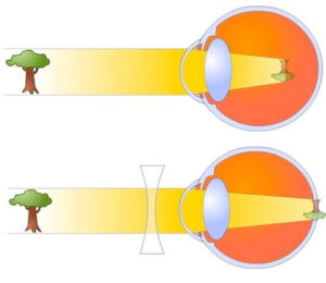 Hyperopia | Potters Bar Eyecare
